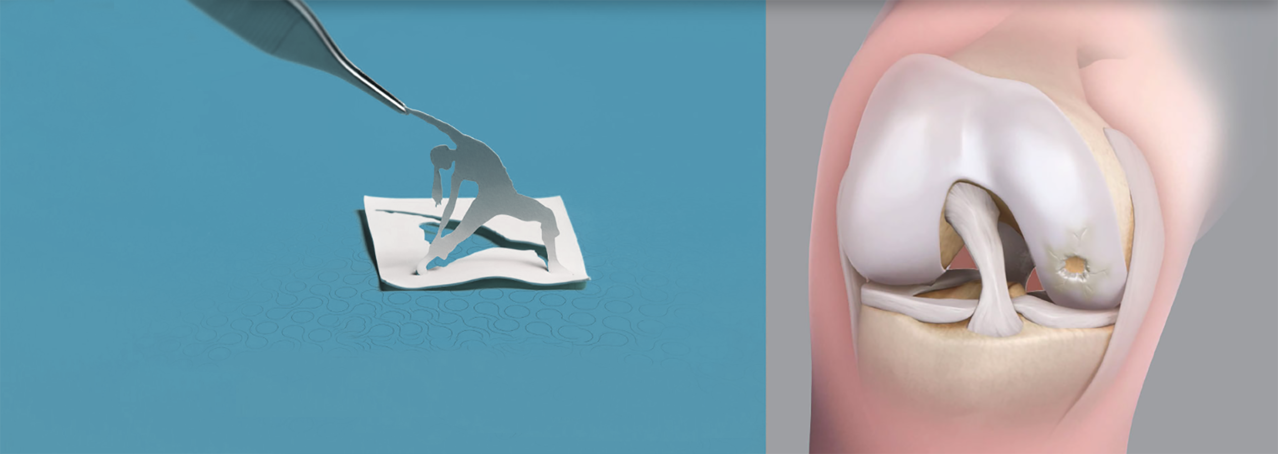 MACI - Cartilage Implant