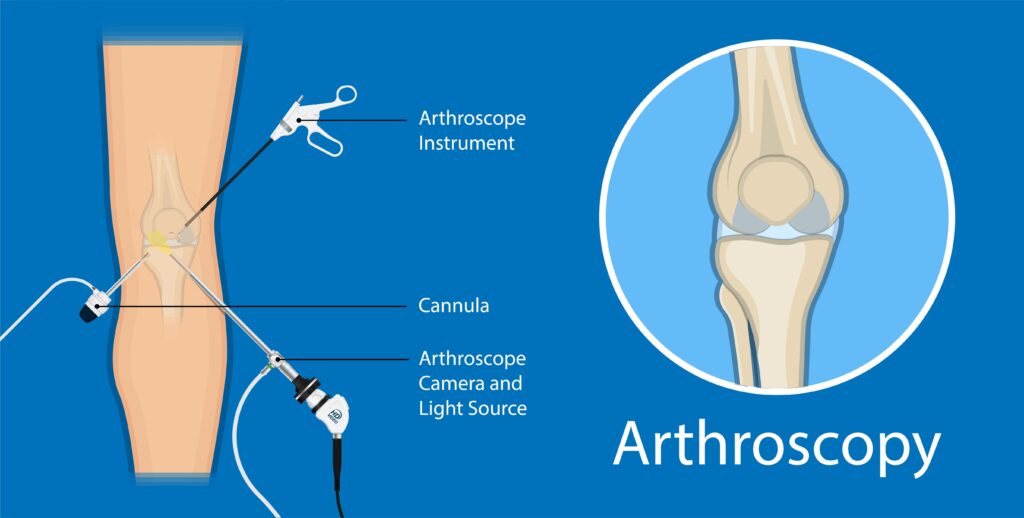 Unlocking Joint Healing: The Revolutionary Promise of Arthroscopy - AOSMI