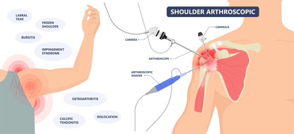 Arthroscopic Rotator Cuff Surgery: What You Need to Know - AOSMI