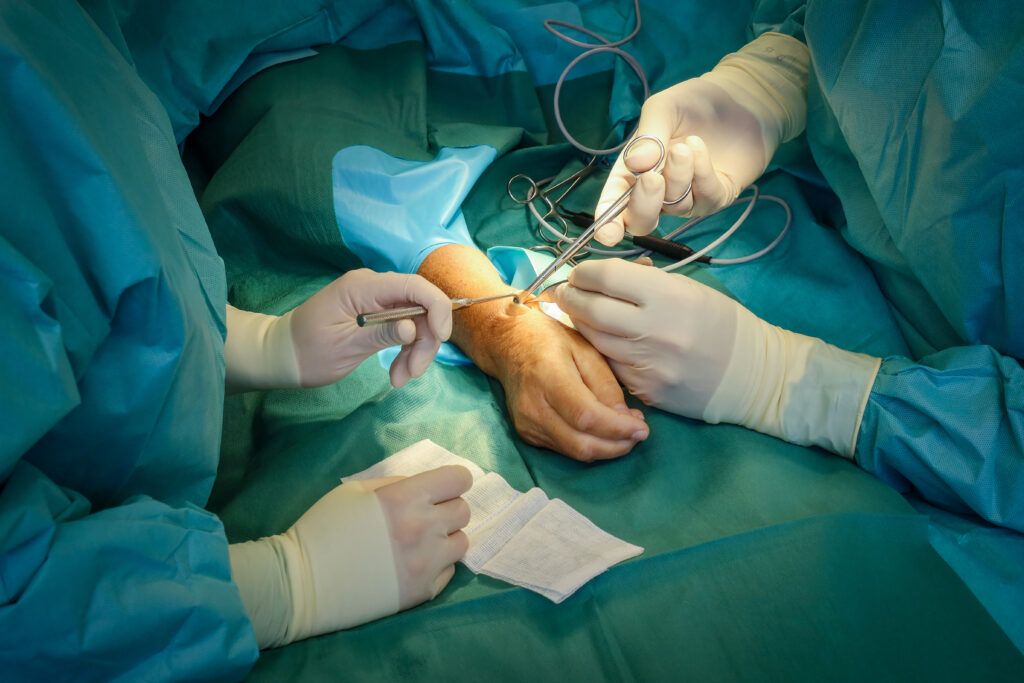Revolutionizing Hand and Upper Extremity Procedures